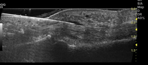 Triggervinger? Snel een effectieve behandeling – Echozorg